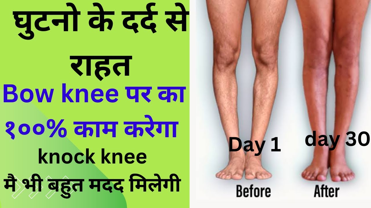 bow legs correction exercise / knock knees correction exercise घुटनो के ...