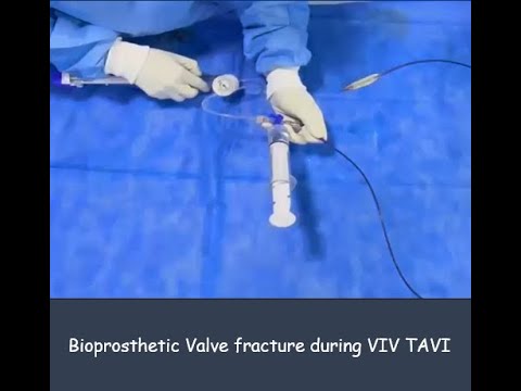 Bioprosthetic Valve fracture during VIV TAVI - YouTube
