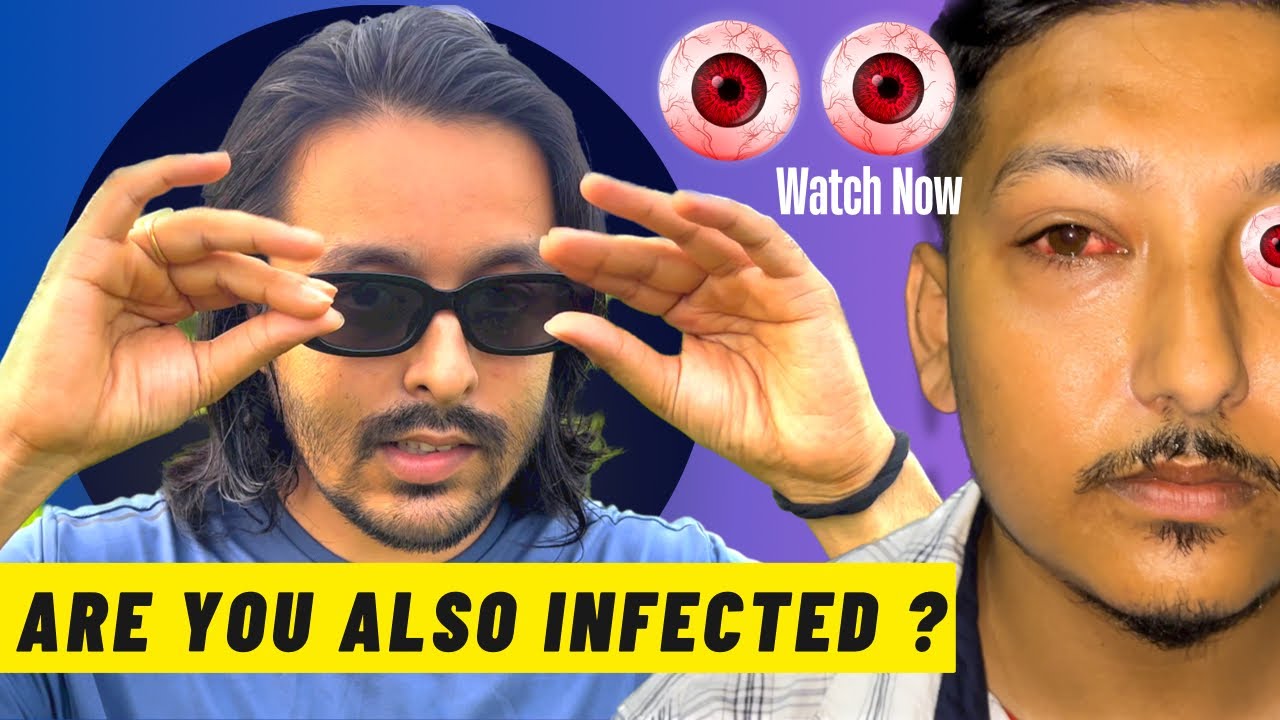 Real Life Conjunctivitis Infected Patient 😰 Conjunctivitis Explain 👀 ...
