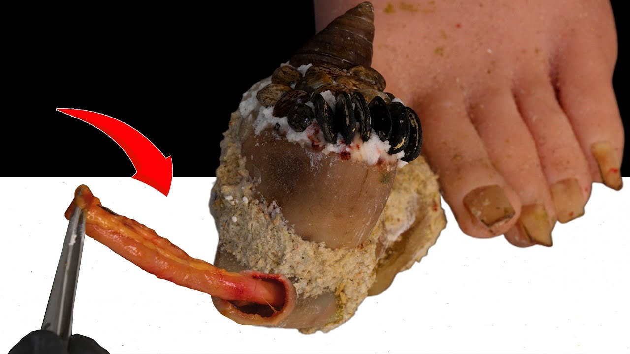 Amazingly Long Toenails, Abnormal Growth Of Black Mud | Professional ...