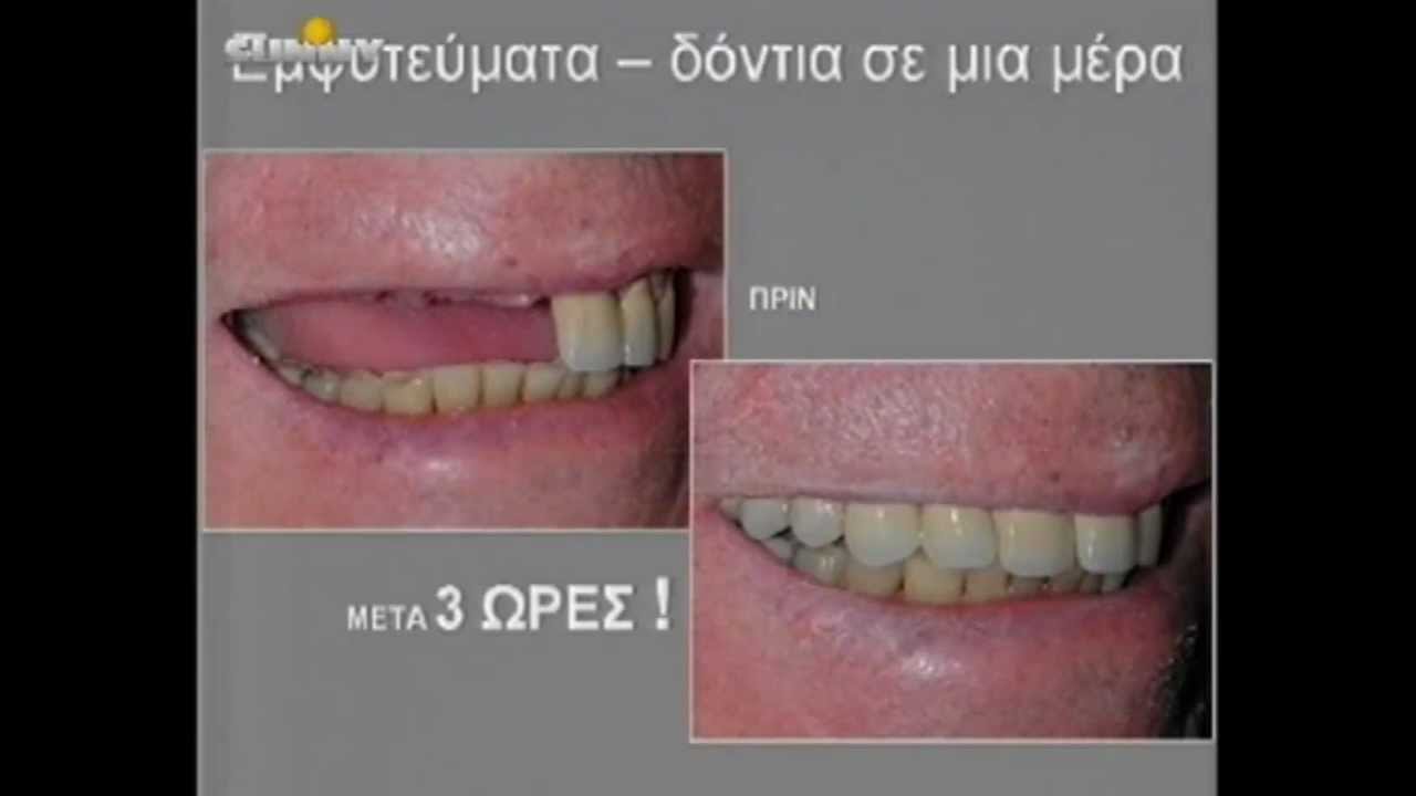 Εμφυτεύματα Δοντιών & Άμεση Φόρτιση - YouTube