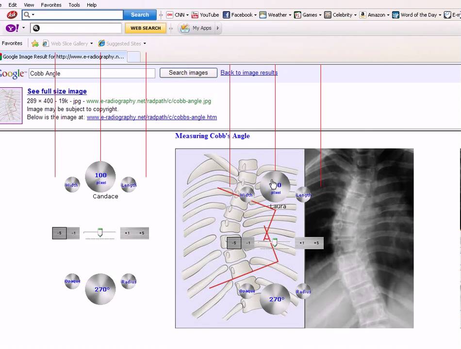 Cobb Angle Measurement - YouTube