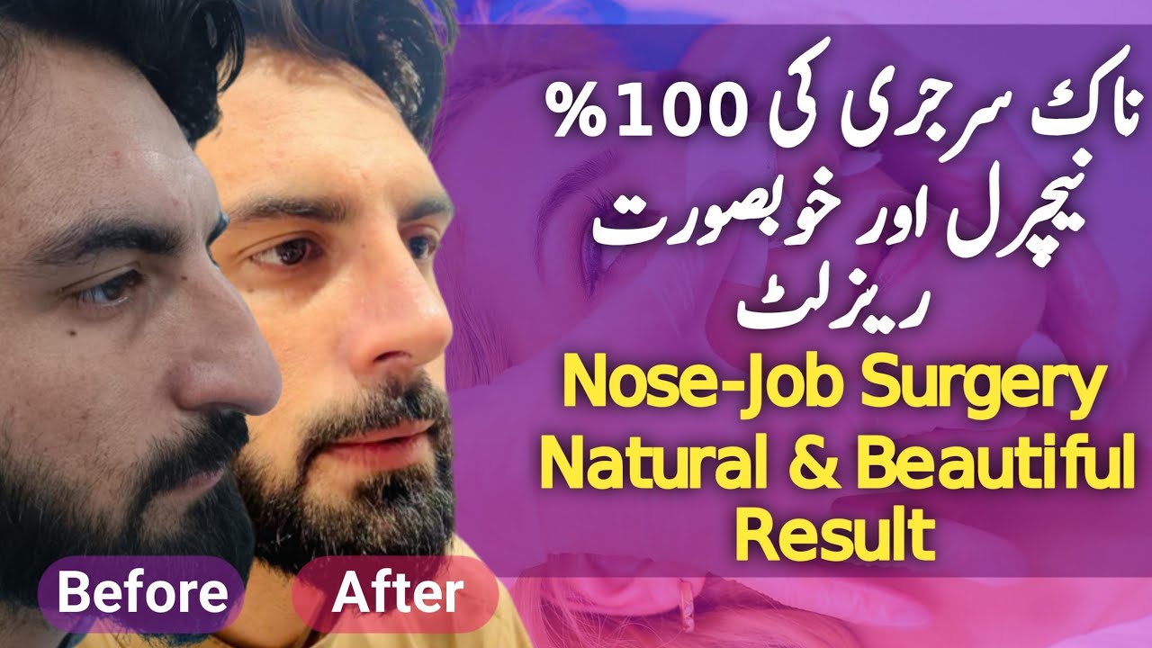Rhinoplasty Before & After Results | Nose-Job Transformation | Dr ...