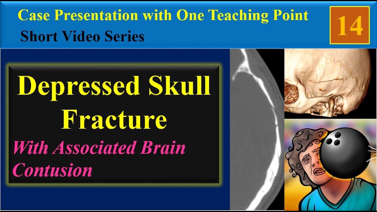 Depressed Skull Fracture, With Associated Brain Contusion - YouTube
