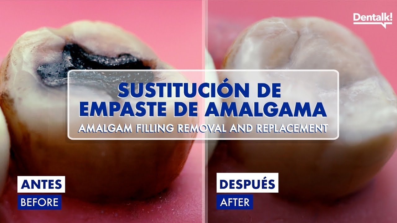 EMPASTE METÁLICO de AMALGAMA - Así se CAMBIA por uno de RESINA PASO a ...