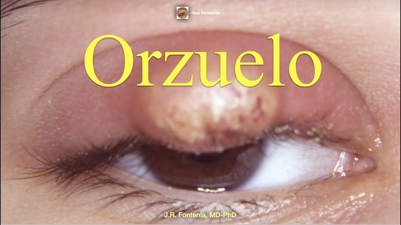 Orzuelo Interno y Orzuelo Externo (Quiste de Zeiss). - YouTube