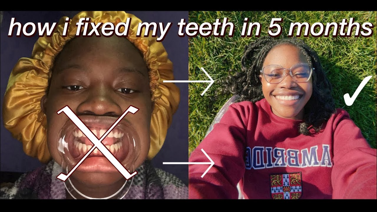 How I fixed my teeth on my own in 5 MONTHS ☆ no braces - YouTube