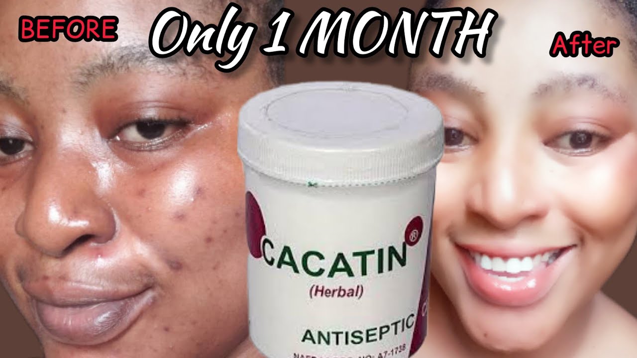 cacatin herbal antiseptic cream(shocking 🥺 review)#skincareinnigeria # ...