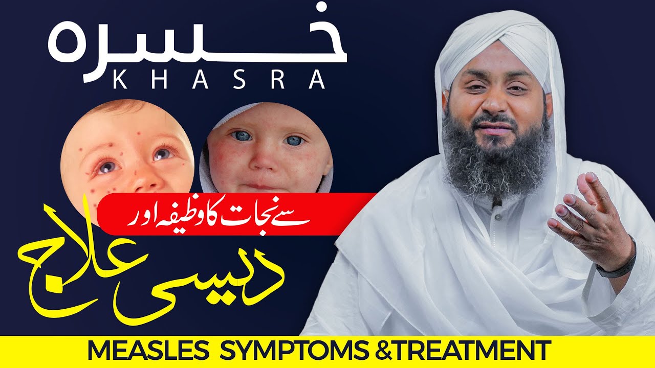 Khasra Ki Bimari Ka Khas Wazifa | Measles Symptoms & Treatment ...