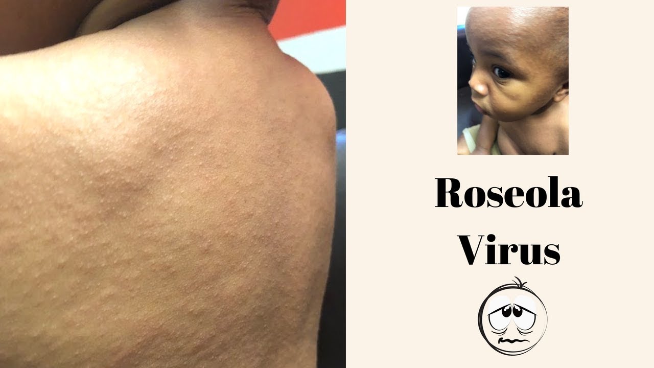 Roseola| Baby update - YouTube