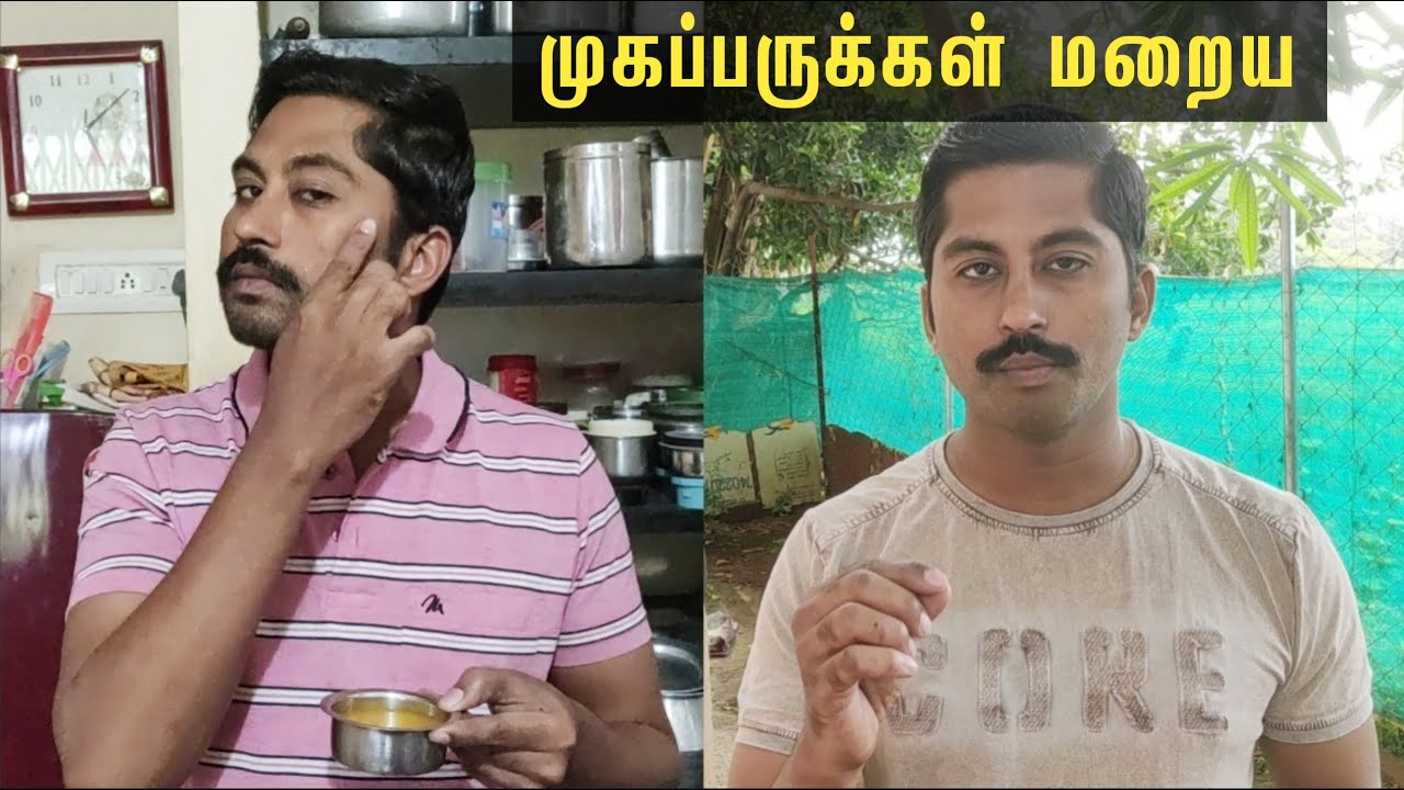 முகப்பரு நீங்க 3 எளிமையான வழிகள் | mugaparu neenga in tamil | Pimples ...