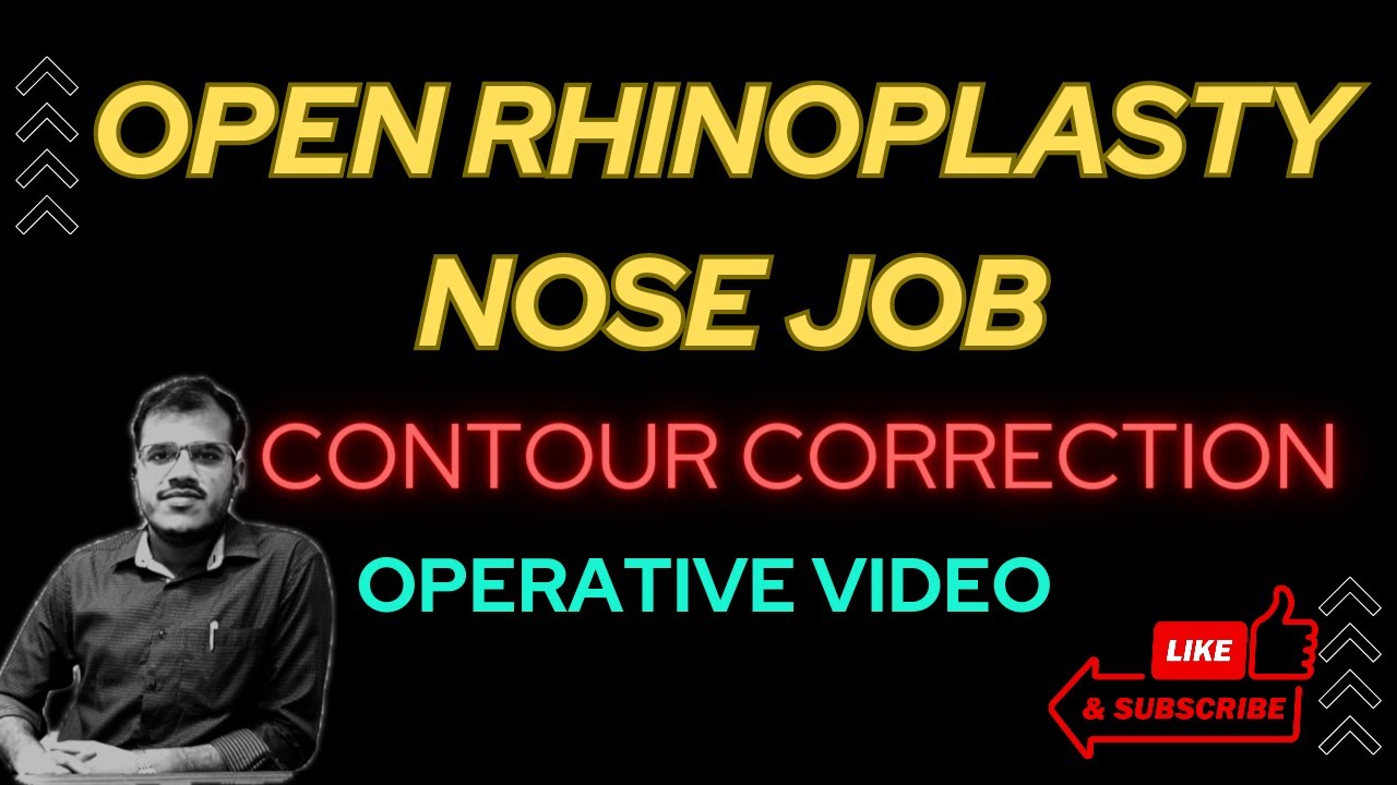 OPEN RHINOPLASTY | NOSE JOB | NOSE COSMETIC SURGERY - YouTube