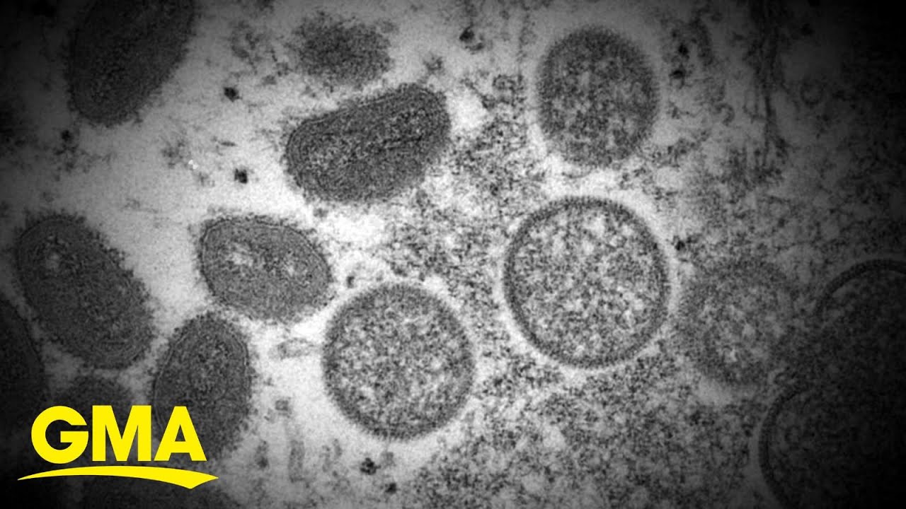 Monkeypox cases rise as US declares public health emergency | GMA - YouTube