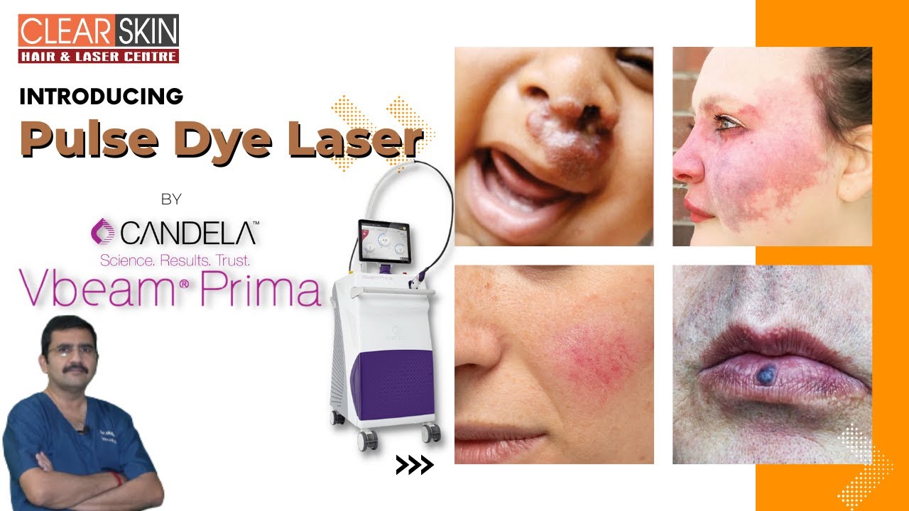 Pulse Dye Laser Treatment By Candela Vbeam Prima by Dr.N.Kailash ...