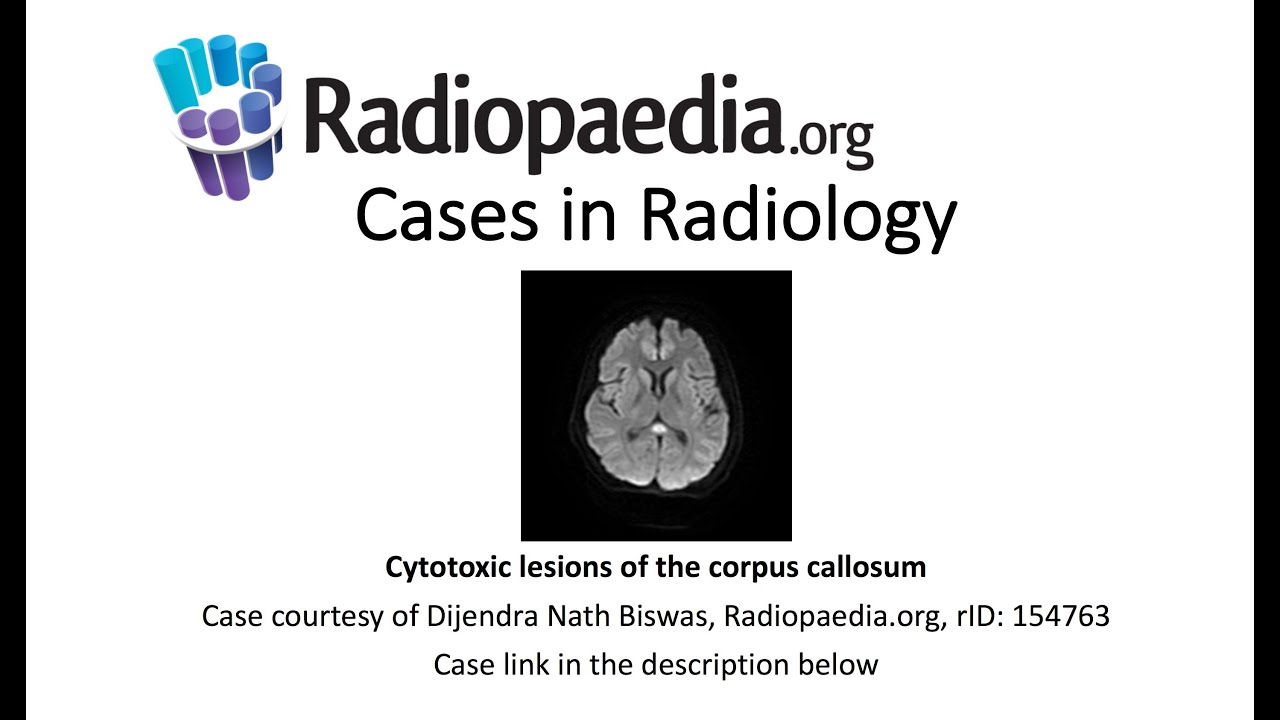 Cytotoxic lesions of the corpus callosum (Radiopaedia.org) Cases in ...