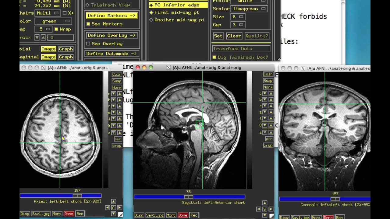 AFNI Talairach Warping: Manual - YouTube