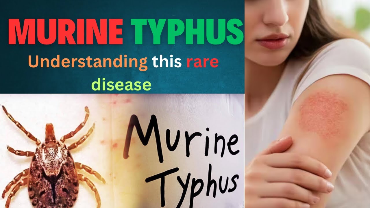 #Murine Typhus - YouTube
