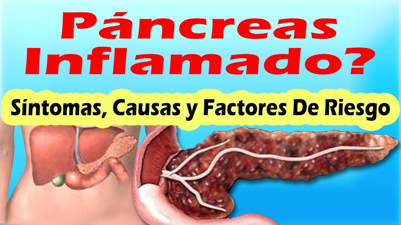 SINTOMAS DE PANCREATITIS AGUDA Y CRONICA Sintomas Del Pancreas ...
