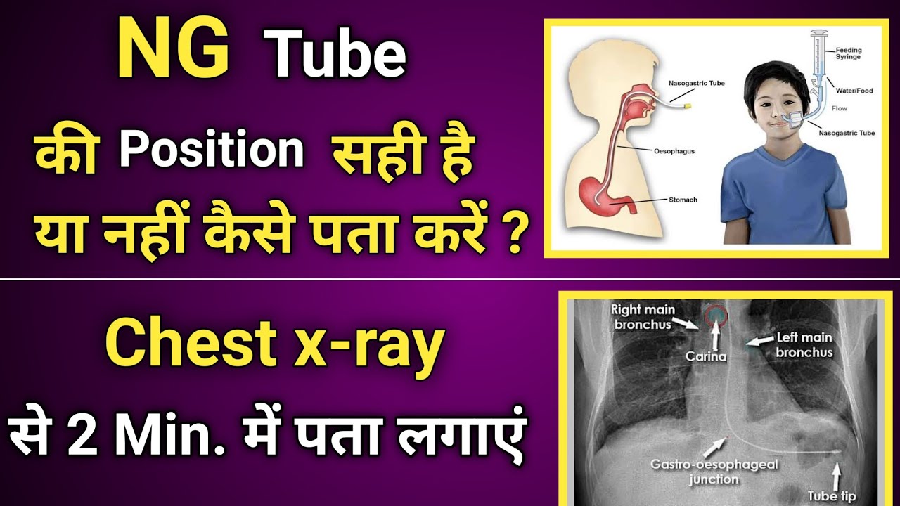 nasogastric tube insertion | NG Tube position - Identification By CXR ...