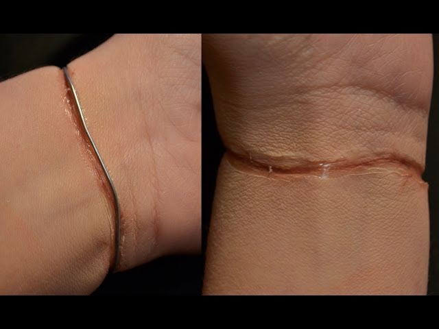 Ligature Marks