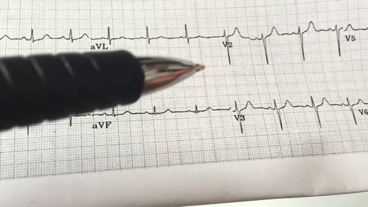 How to determine ECG axis - YouTube