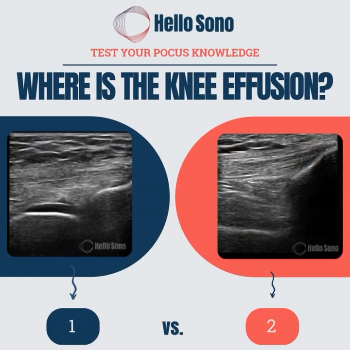 Knee effusion vs. normal knee on ultrasound. #pocus #meded #ultrasound ...