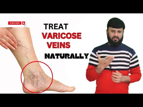 VARICOSE VEINS/ULCER/PERMANENTE TREATMENT/TREAT NATURALLY/ HIJAMA# ...