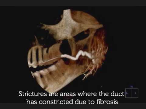 3D rendering of sialogram demonstrating sialodochitis - YouTube