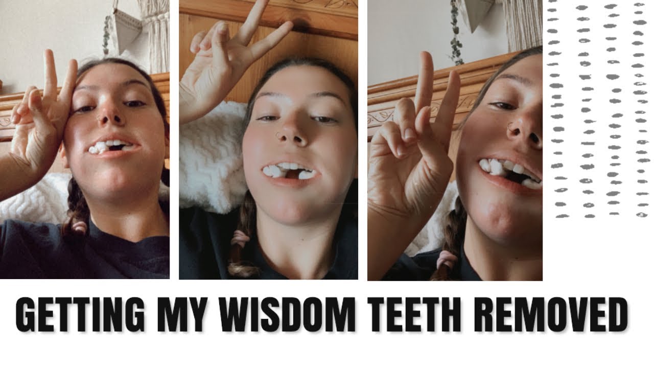 MY WISDOM TEETH REMOVAL FUNNY | i literally cried over ice cream ...