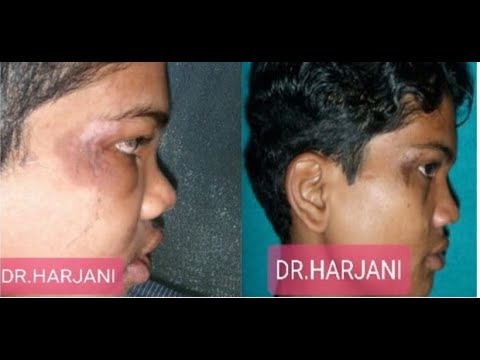 Face Trauma Surgery Before After - YouTube