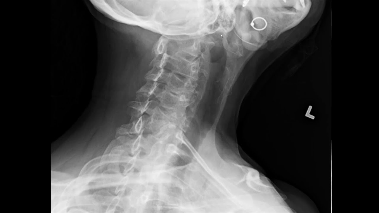 Cervical Thoracic spondylolisthesis and deformity - YouTube