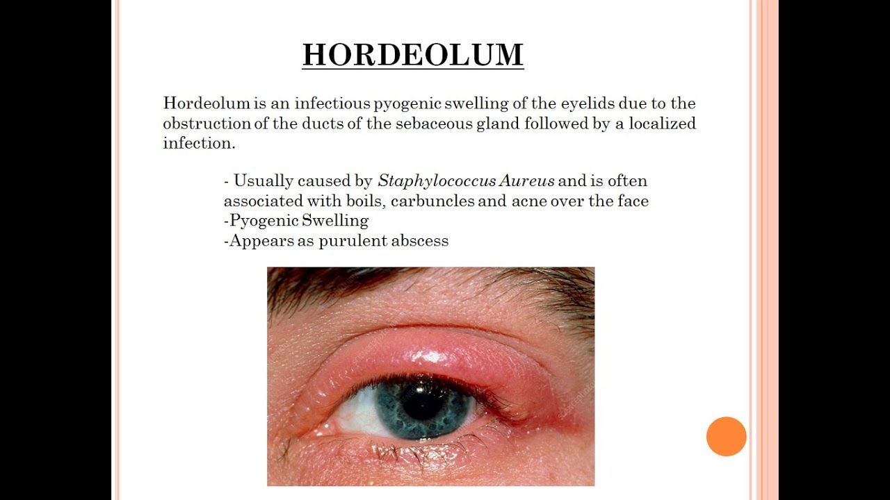Diseases Of Eyelids 2 Hordeolum Hordeolum Externum And Hordeolum