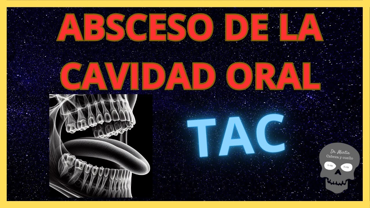 ABSCESO de la cavidad ORAL👉Hallazgos Radiológicos - YouTube