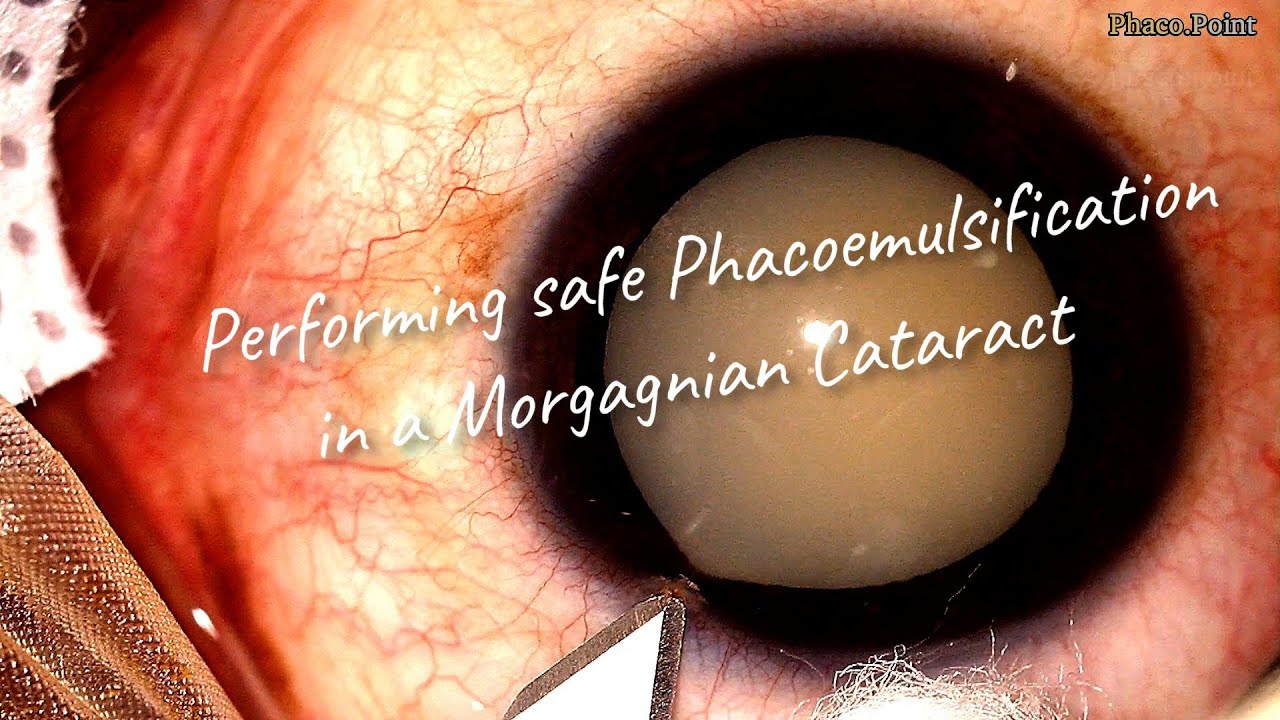 Performing Safe Phacoemulsification in a Morgagnian cataract - YouTube