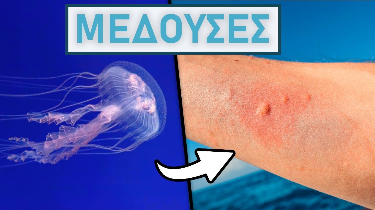 Δείτε τι πρέπει *και τι δεν πρέπει* να κάνετε εάν σας τσιμπήσει ...