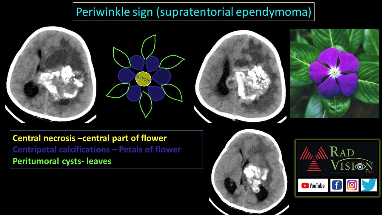 SIGNS IN RADIOLOGY -SET III - YouTube