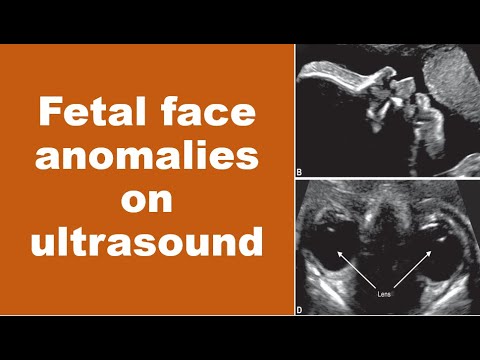 Fetal face anomalies on ultrasound - YouTube
