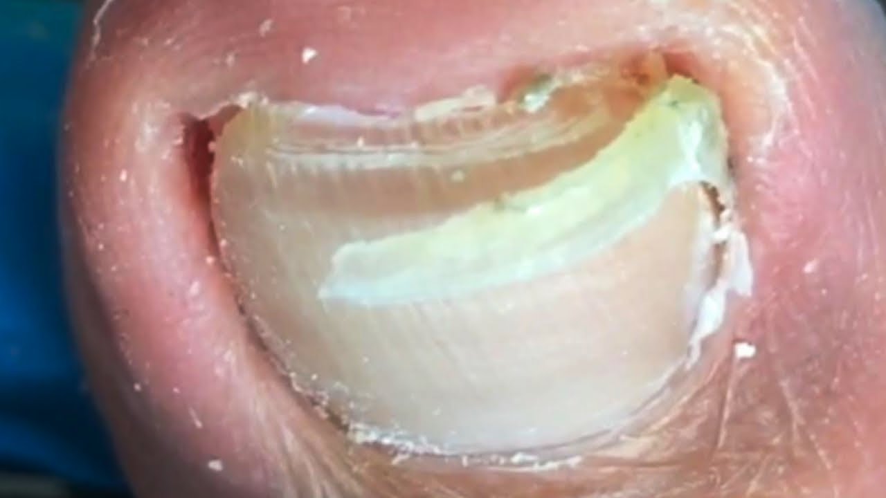 Trim toenails and clean ingrown toenails thoroughly - YouTube