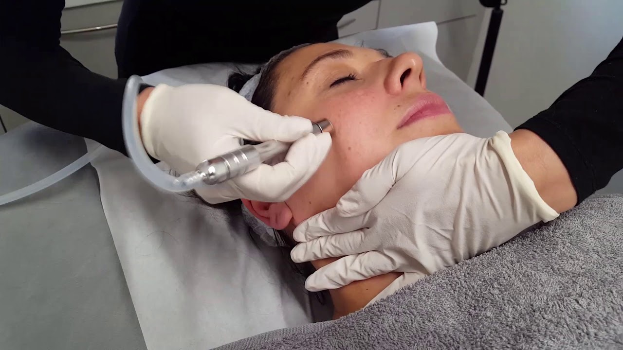 Diamond Tip Microdermabrasion At Dentobeauty Grays Essex Youtube