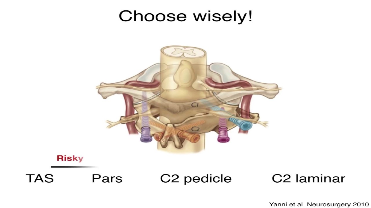 How to tackle vertebral artery injury in craniovertebral spine surgery ...