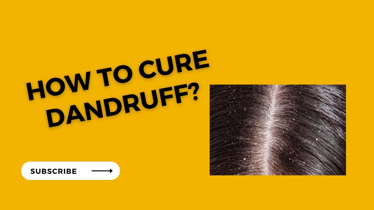 How to cure dandruff? - YouTube
