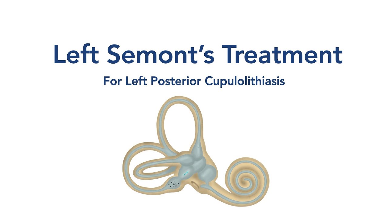 At Home Left Semont's Treatment for BPPV Vertigo - YouTube