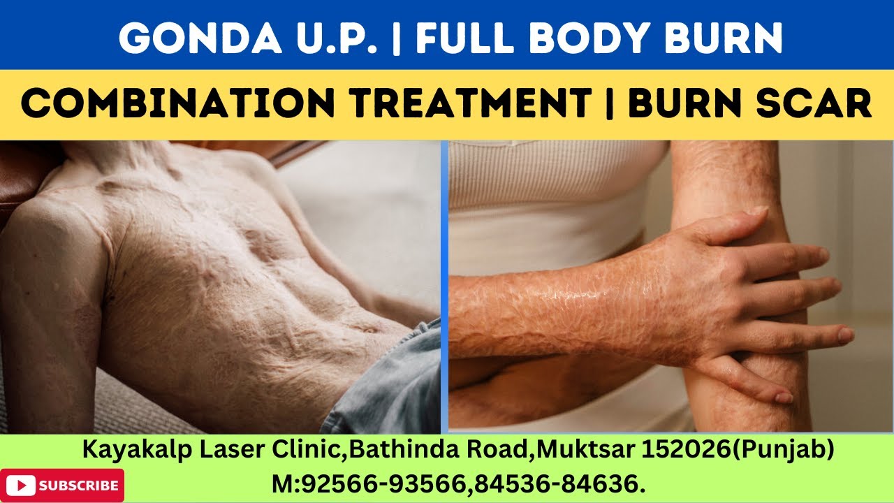 Gonda U.P. | Full Body Burn | Combination Treatment | Burn Scar ...