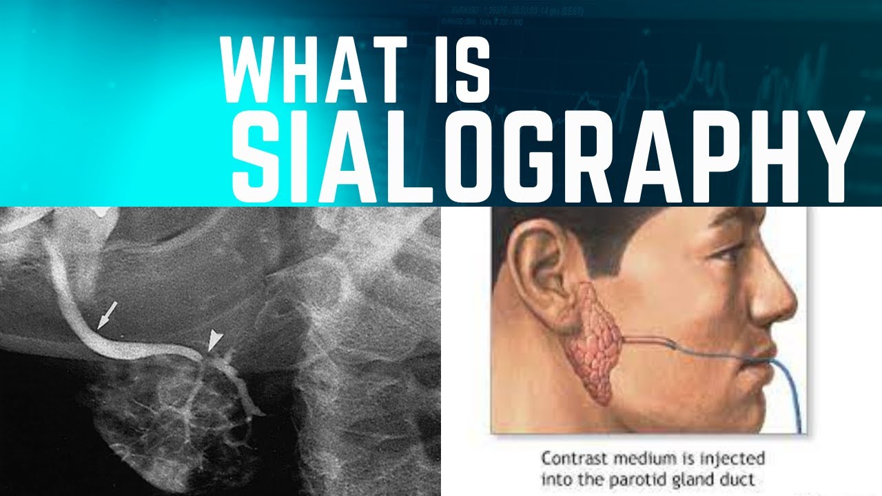 Sialography X-ray Procedure|Sialography Procedure |In Urdu|Hindi @ Easy ...