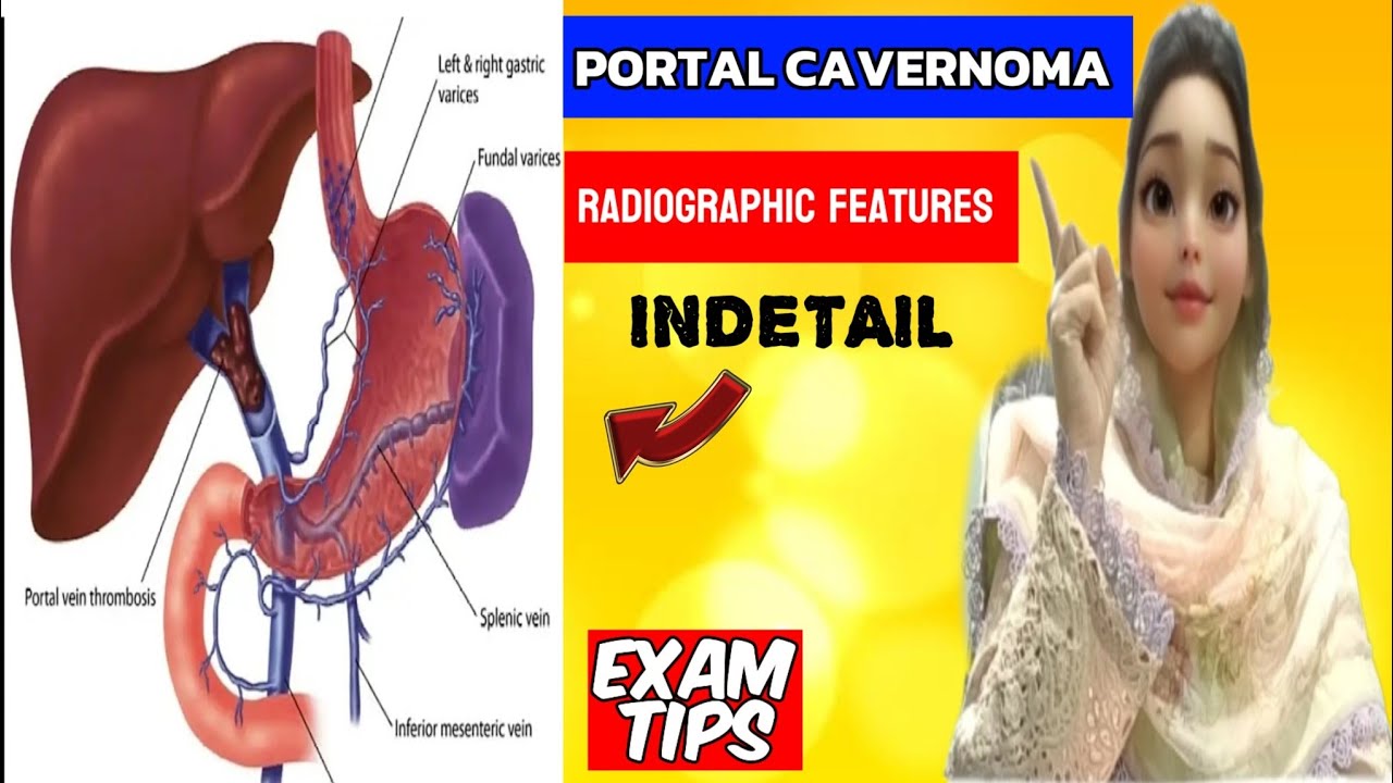 Cavernous Transformation of Portal Vein | Portal Vein thrombosis ...