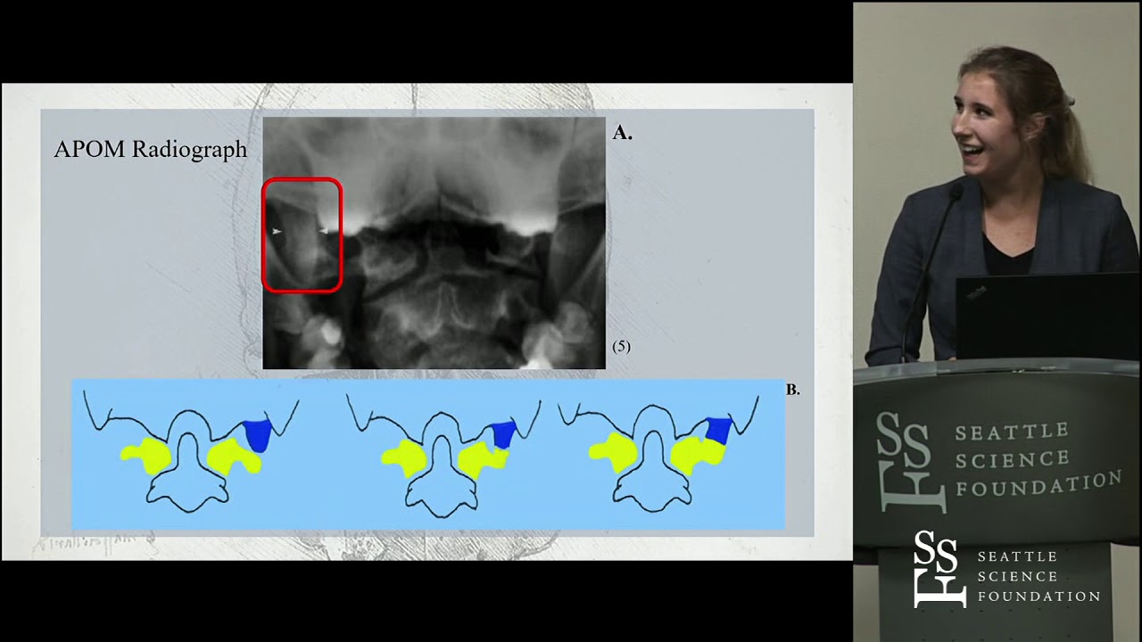 The Paramastoid Process: Anatomy and Clinical Implications - Maia ...
