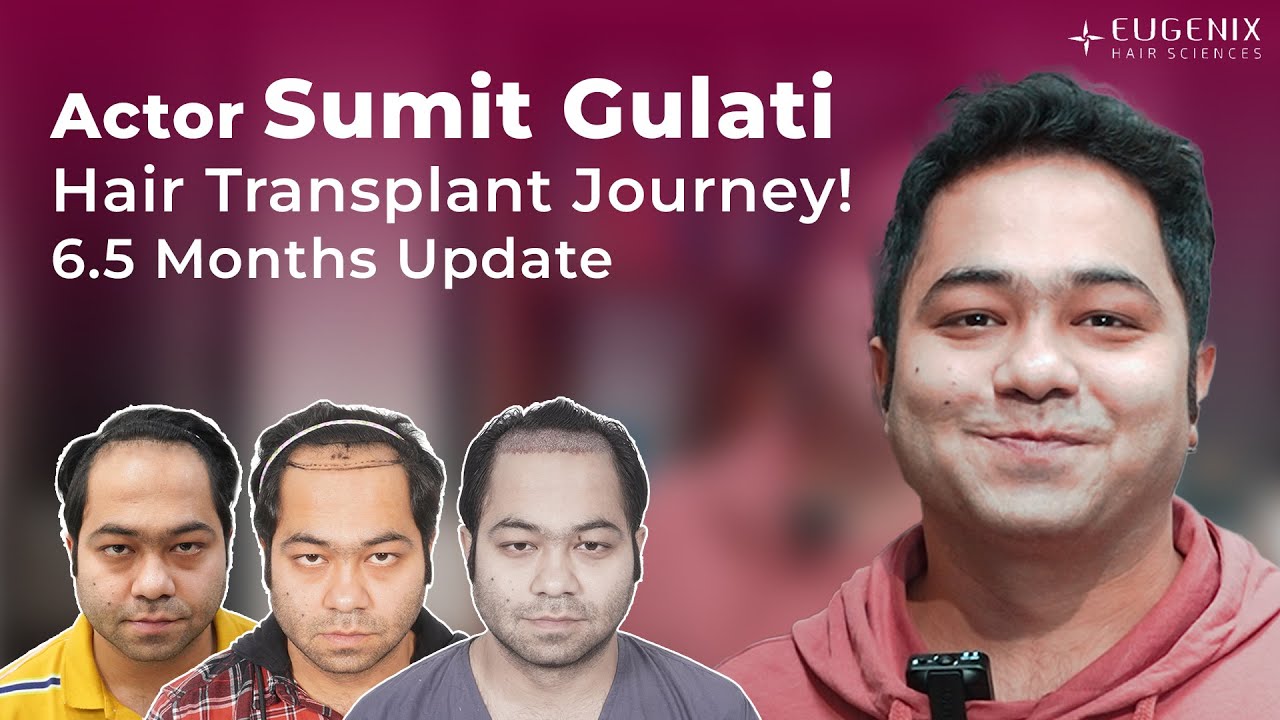 Sumit Gulati | Bollywood Actor Hair Transplant Results at Eugenix Hair ...