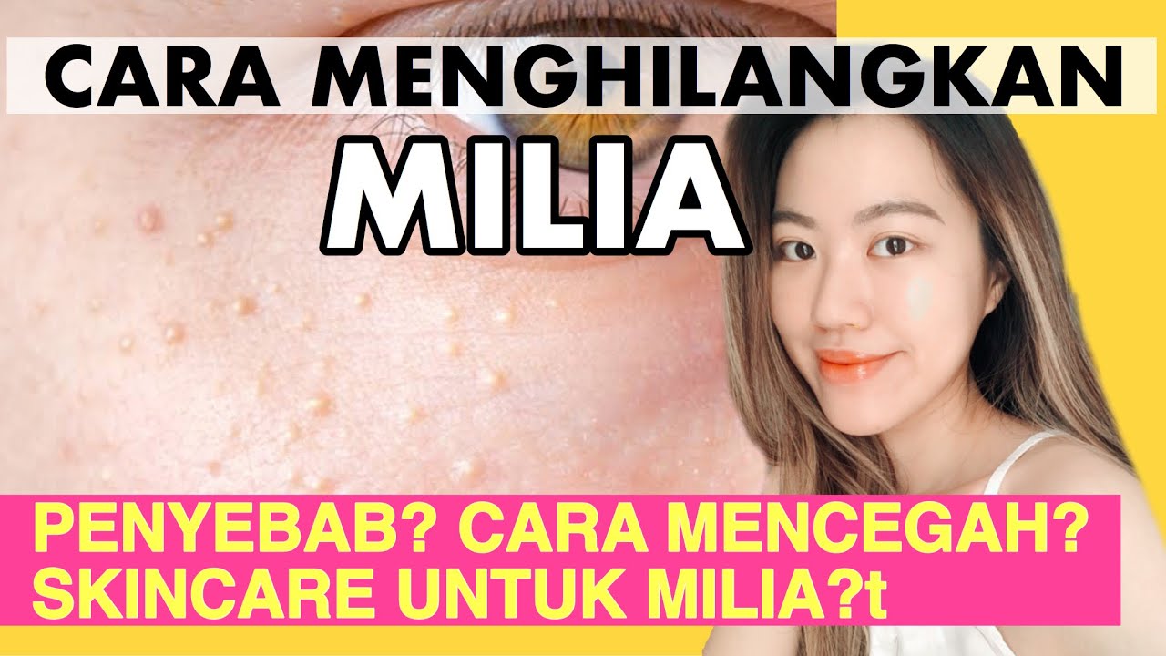 BAGAIMANA CARA MENGATASI DAN MENGHILANGKAN MILIA? SKINCARE UNTUK MILIA ...