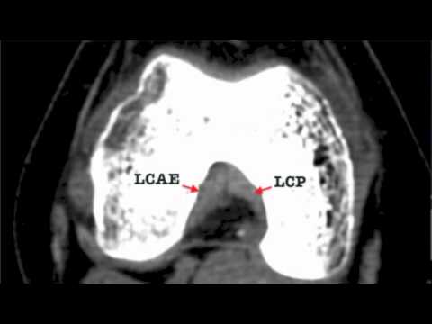 Ligaments croises du genou et Scanner 3D - YouTube