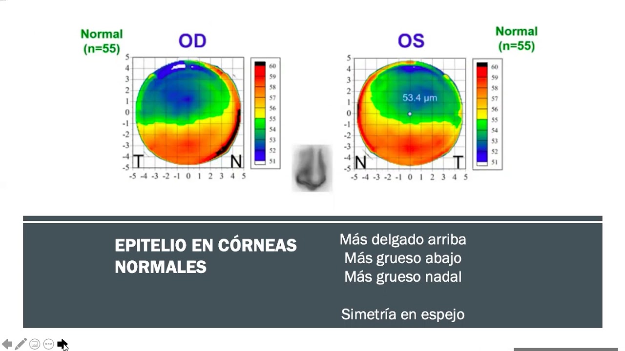 La importancia del epitelio corneal para el cirujano refractivo y de ...